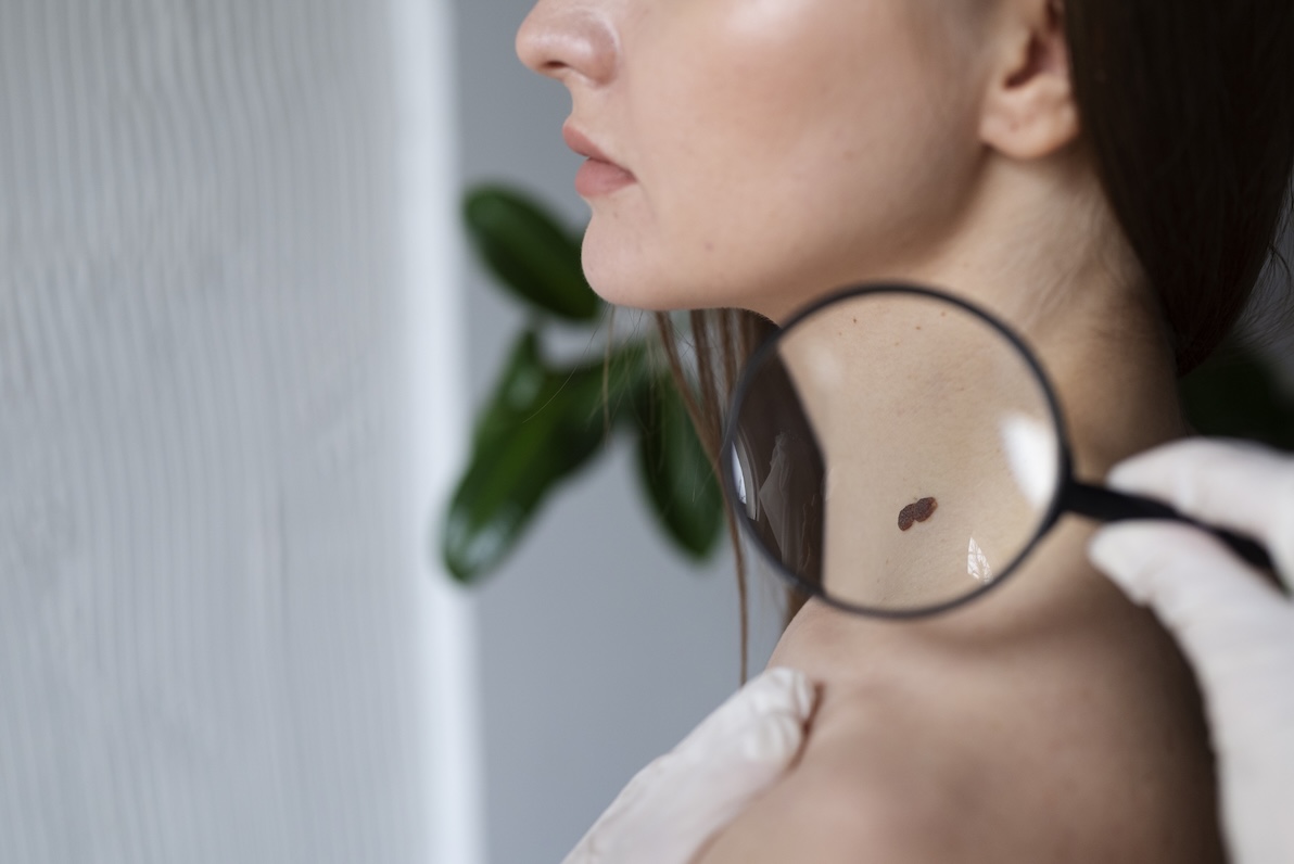 Early Melanoma in Rocky Mount | Amazing Grace Aesthetics